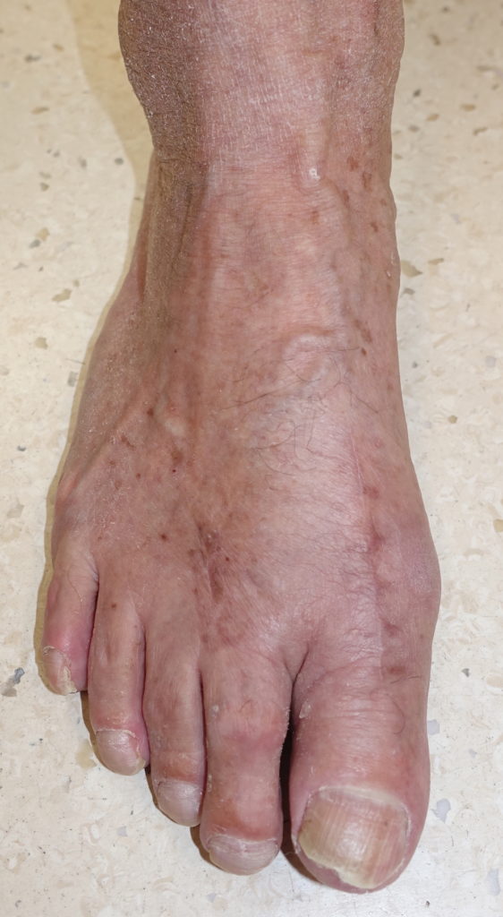 » 1st-mtpj-fusion-6-weeks-post-op-clinical-photo