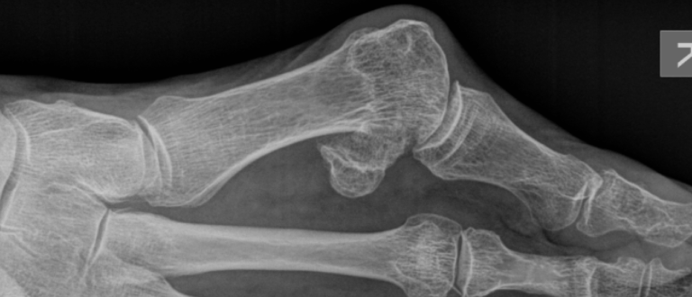 » 1st-mtpj-fusion-pre-op-xr