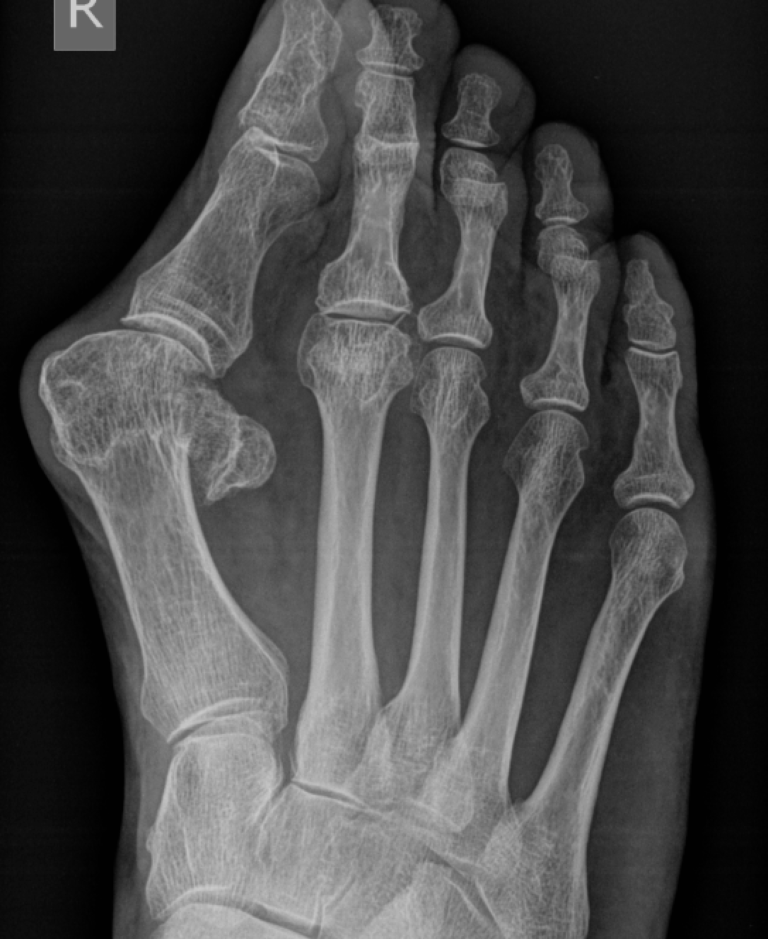 » 1st-mtpj-fusion-pre-op-xr