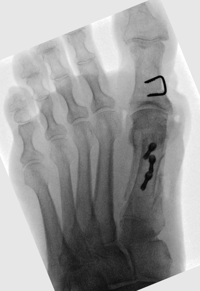 » intra-op-xr-of-scarf-and-akin-osteotomies