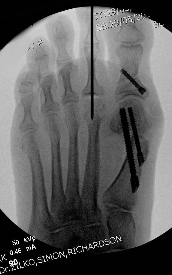 » minimally-invasive-bunion-correction-intra-op-xr