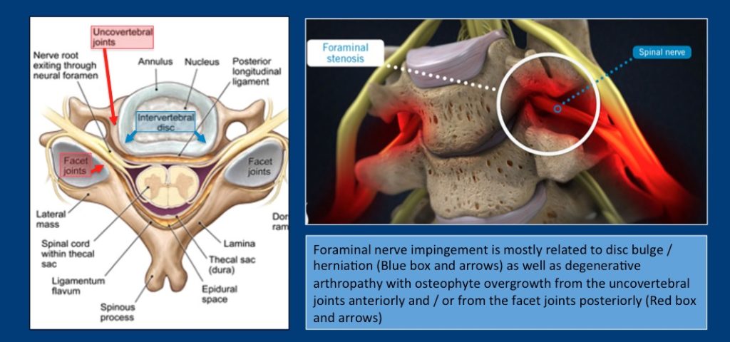 » radiculopathy-anatomy
